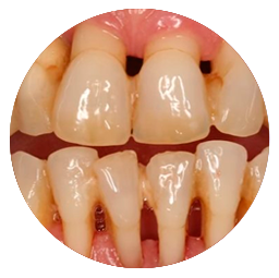 Periodoncia – Denticlinic clínica dental